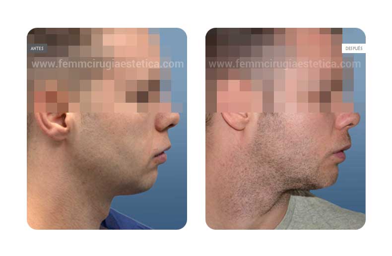 Mentoplastia y Cirugía de Mentón | Clínica FEMM